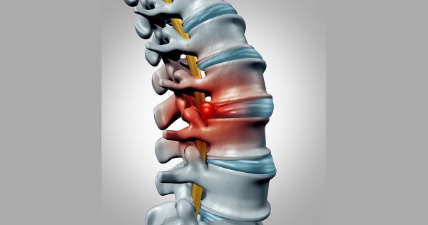 Herniated Discs and Sciatica | The Orthopaedic Therapy Clinic